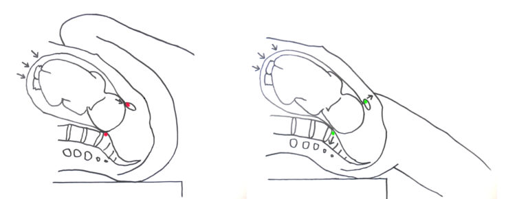 Was tun … bei Geburtsstillstand, weil das Baby nicht ins Becken will ...